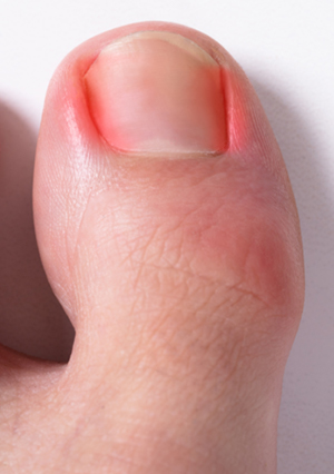 Ingrown Toenail Treatment - Adelaide Foot Doctor